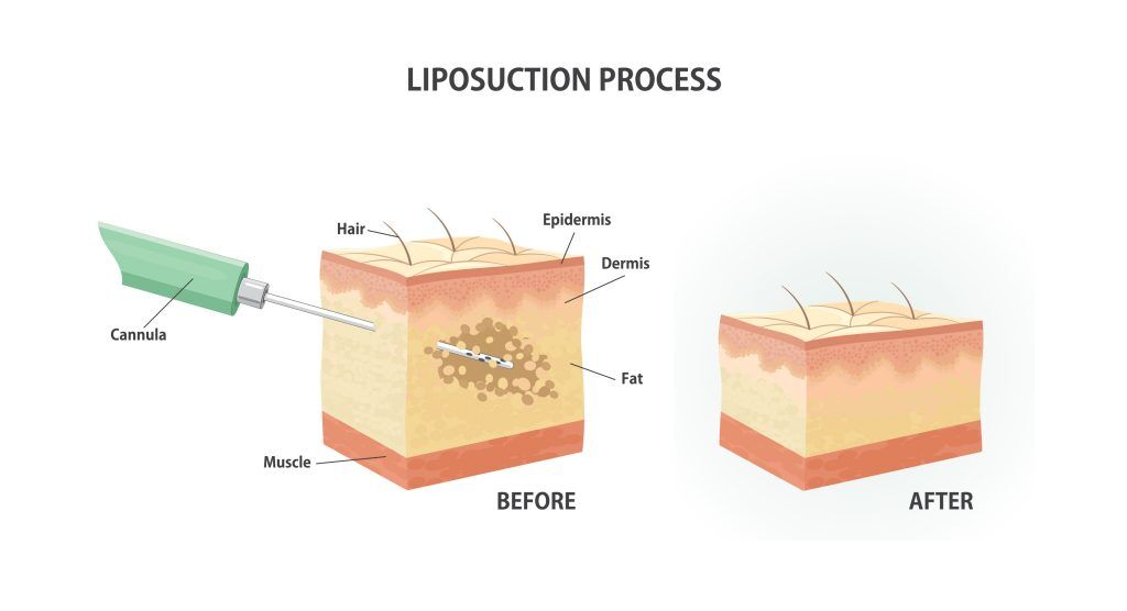 Tips To Speed Up Your Recovery After Liposuction - The Liposuction ...